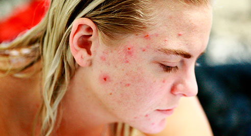 Acne in summer: can the sun cause pimples? - SaberVivir